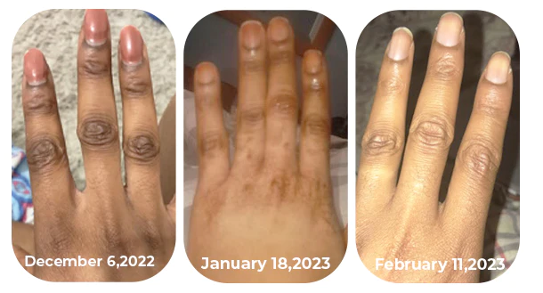 Dark knuckles - My Blog